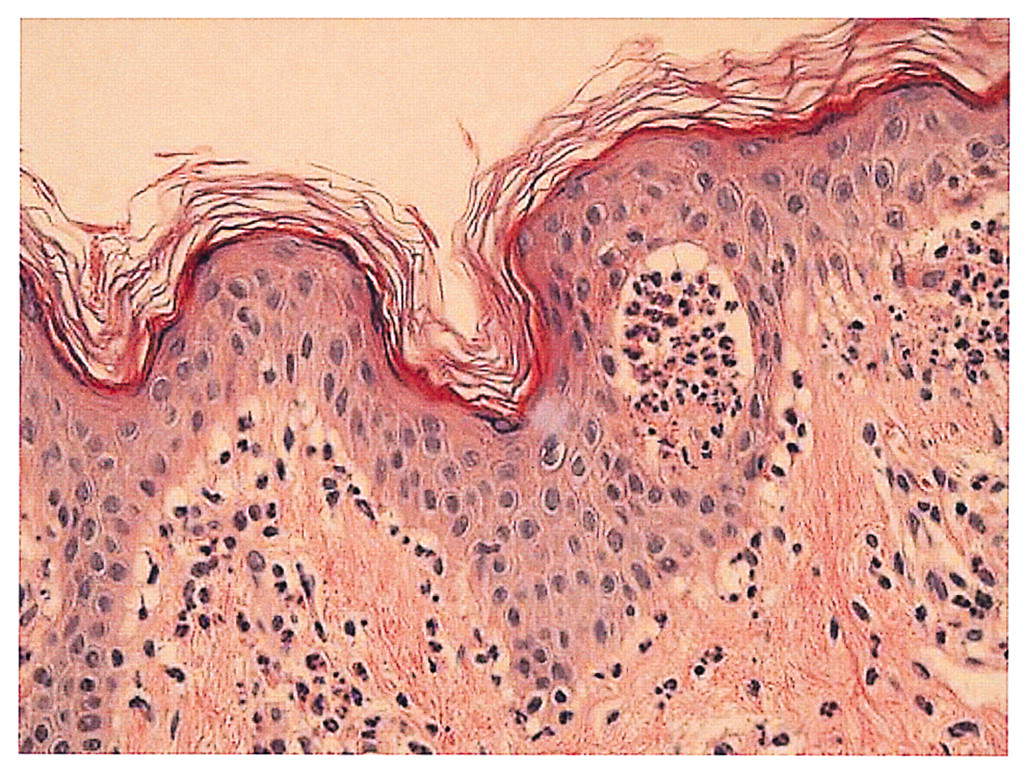 Early Diagnosis Is Key in Vancomycin-Induced Linear IgA Bullous ...