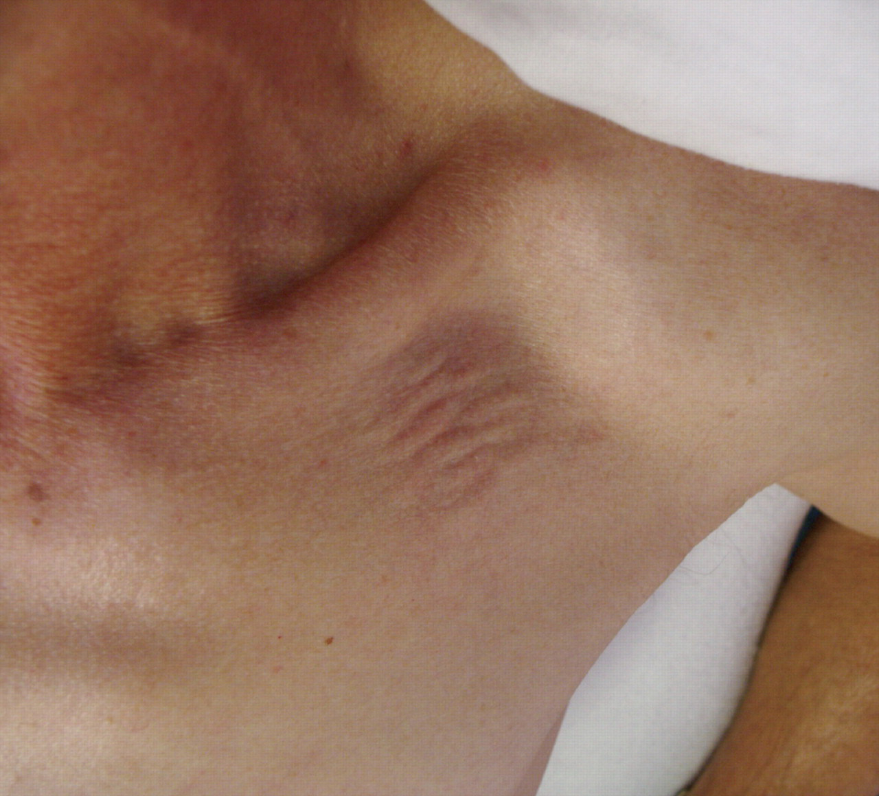 Lymphatic Drainage of the Neuraxis in Chronic Fatigue Syndrome: A ...