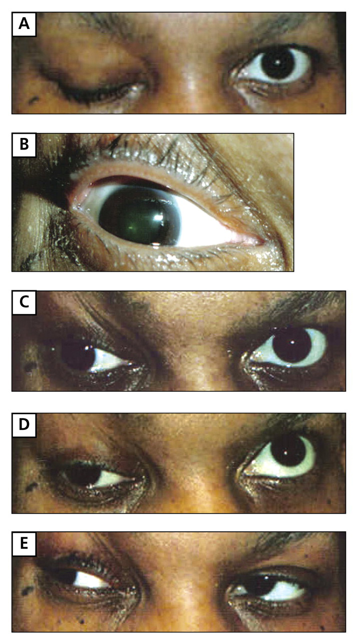 Complete Ophthalmoplegia With Pupillary Involvement as an Initial ...
