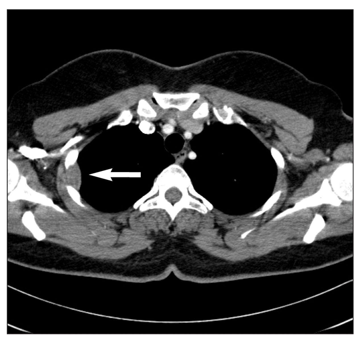 Incidental Pleural-Based Pulmonary Lymphangioma