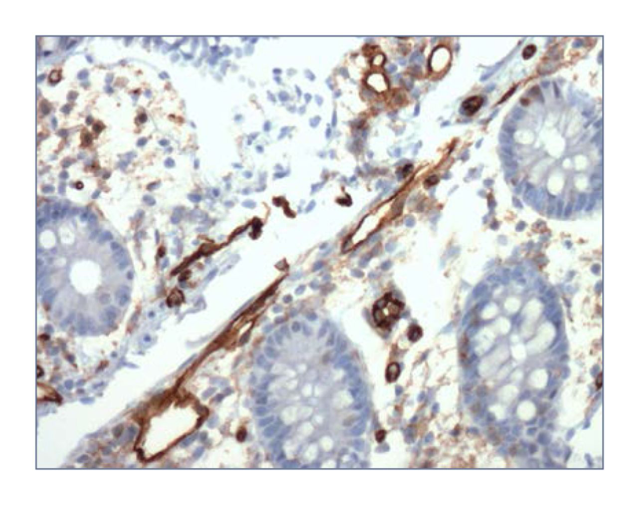 A Case of Idiopathic Colonic Varices