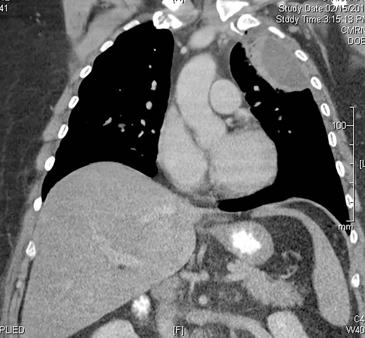 Nontraumatic First Rib Fracture and Empyema Presenting as...