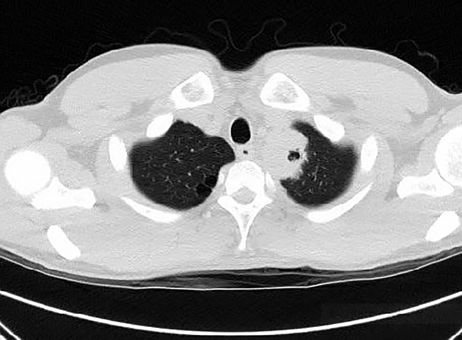 Primary Lung Signet Ring Cell Carcinoma Presenting as a Cavitary ...