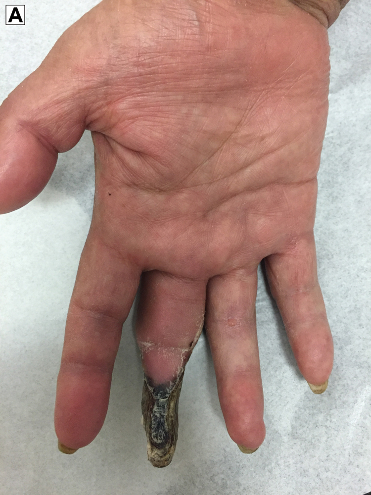 Dry Digital Gangrene