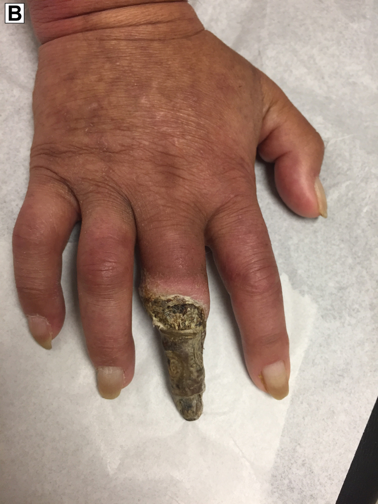 Dry Digital Gangrene