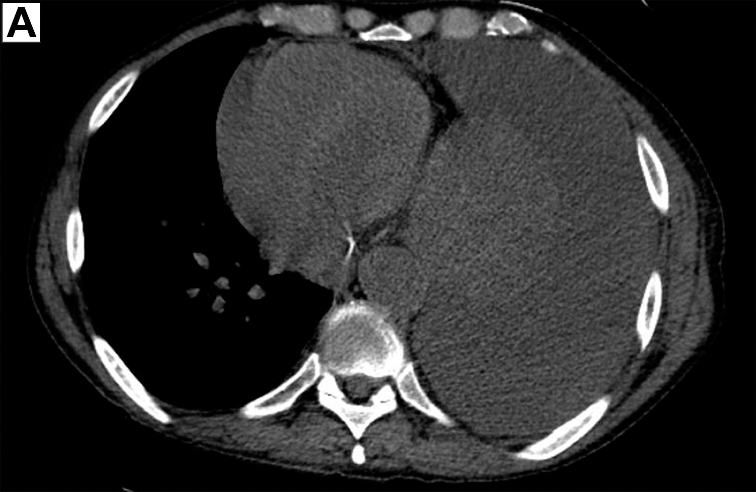 Extracardiac Lung Adenocarcinoma