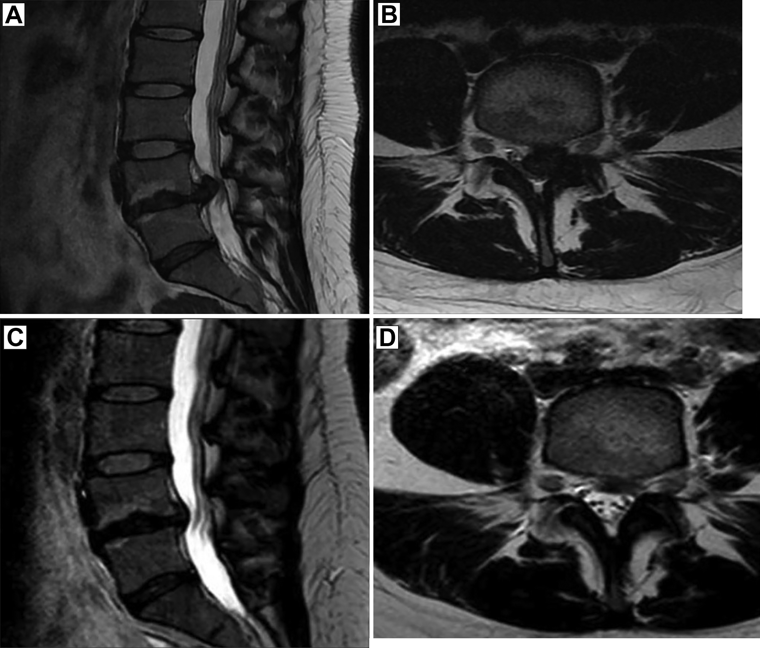 Platelet-Rich Plasma and Epidural Platelet Lysate: Novel ...