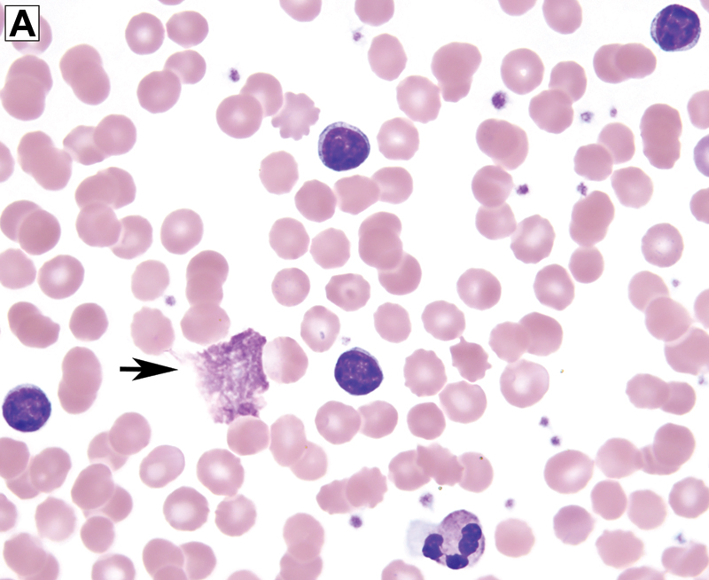 “Soccer-Ball” Lymphocytosis